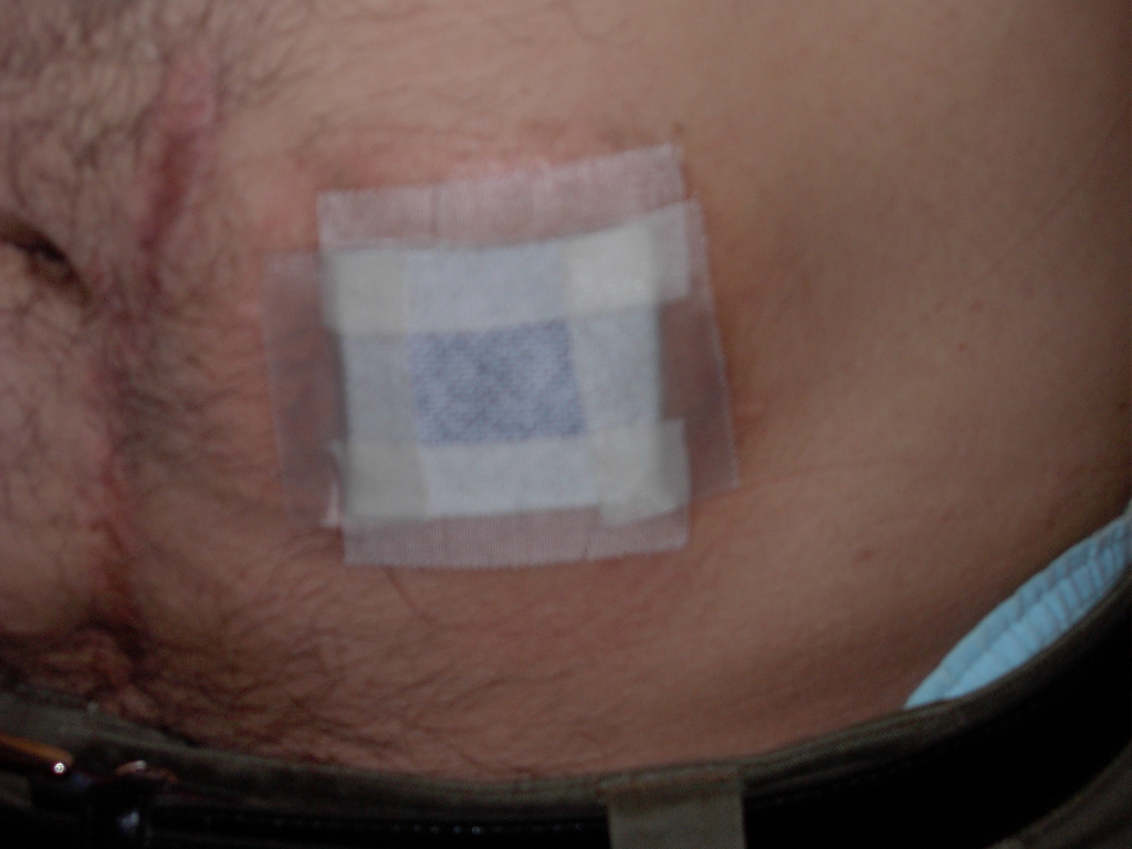 Stoma Gas Deodorizing Patch